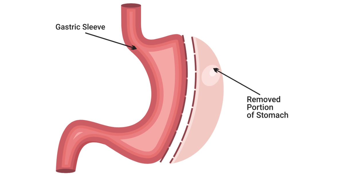 Déroulement d’une sleeve gastrectomie à Charleroi